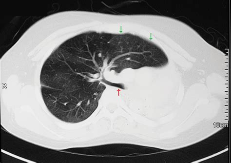 Racgp Unilateral Diffuse Lung Opacification In An Asymptomatic Woman