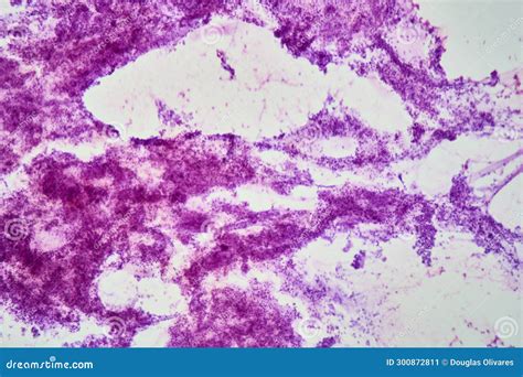 Transbronchial Lung Brushing Of Cryptogenic Organizing Pneumonia Stock
