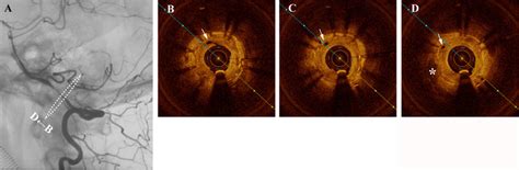 A Middle Aged Female Presented One Year After Intracranial Stenting For Download Scientific