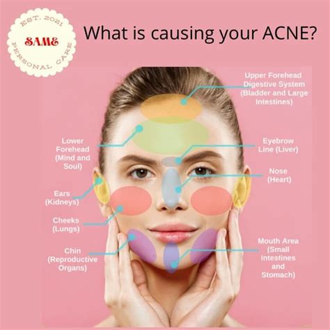Acne Face Map What Your Breakouts Are Trying To Tell You Artofit