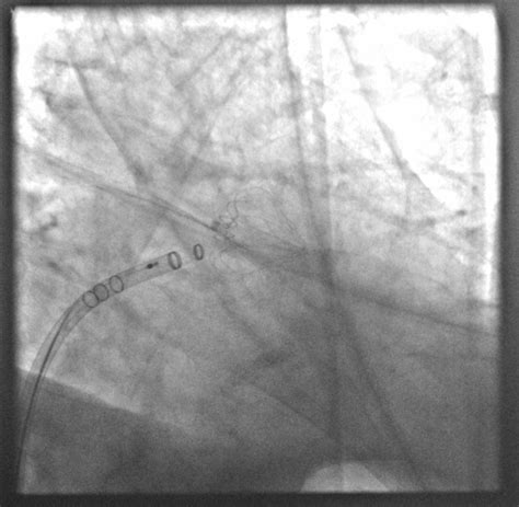 Final Position Of Watchman Device Number 27 Mm In Left Atrial Appendage Download Scientific