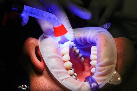 Bacteria That Causes Tooth Decay Might Also Help Colon Cancer Spread