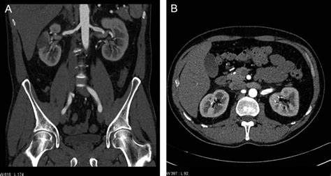 A Cta On Admission Showing The Right Renal Artery Dissection Flap And