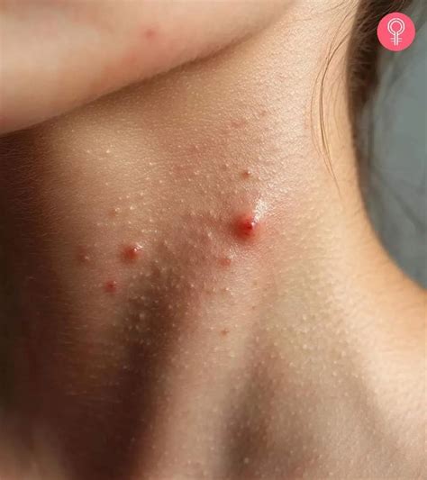 Neck Acne Complete Guide To Causes Treatments And Prevention