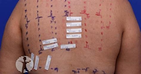 Multiple Positive Patch Tests To Acrylates Image