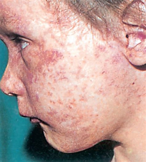 Rubella Clinical Tree