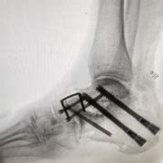 Trigger Points Injections In Neck EmergeOrtho Foothills Region