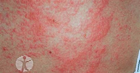 Plant Dermatitis Image