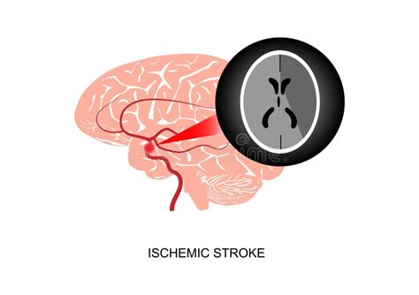 Illustration Of Cerebral Ischemic Stroke And Imaging Stock Illustration Illustration Of
