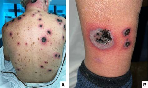 Ecthyma Gangrenosum Of Atypical Origin Internal And Emergency Medicine