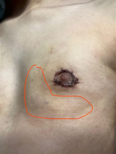 Scar Tissue Build Up 2 Weeks Post Op Keyhole Context In Comments R