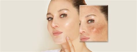 Next Level Approach To Combating Hyperpigmentation