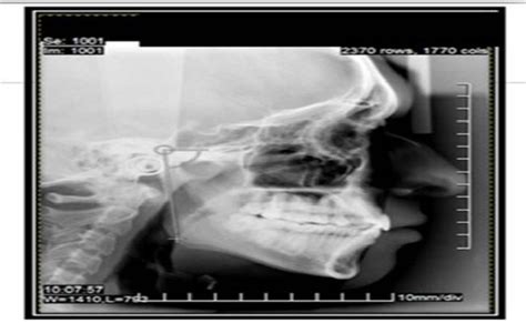 Figure 1 From Sex Determination In Kerala Population Using Morphometric Analysis Of Orbital And