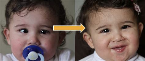 Strabismus Ophthalmology Cases And Hypotheses Och Journal