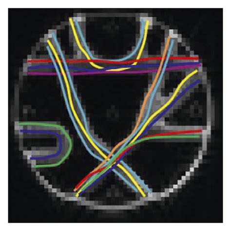fiber pathways tracked with fact nurbs t and nrbs g a spatial seed