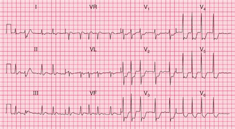 Ecg Case 150 Atrial Fibrillation With Rapid Ventricular Response Rvr