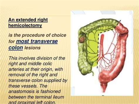Extended Right Hemicolectomy Right Hemicolectomy Nffo