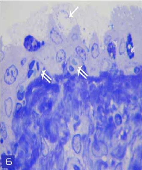 An Umbrella Superficial Cell With Karyolytic Nucleus ↑ Together With