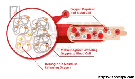 Methemoglobinemia Symptoms