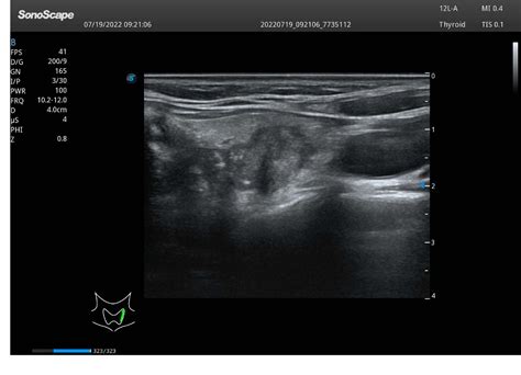 Figure 1 From Comparison Of Diagnostic Values Of Acr Ti Rads Versus C Tirads Scoring And