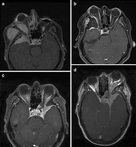 Gadolinium Enhanced Axial T1 Weighted Mr Fat Suppression Sequence