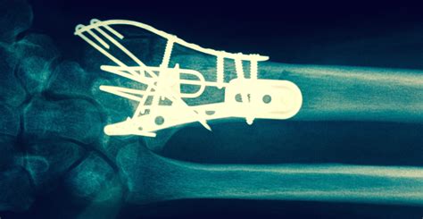 Broken Wrist Colles Fracture Treatment Brisbane