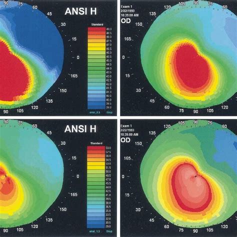 Histogram Of Normal Corneal Powers By Corneal Topography Corneal Power