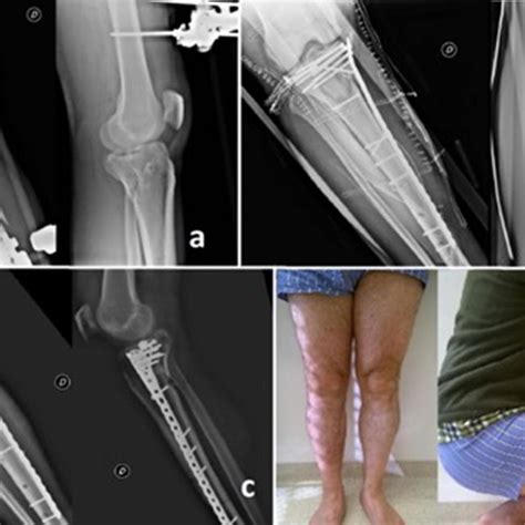 A Year Old Woman Reporting A High Energy Proximal Tibia Trauma A Download Scientific