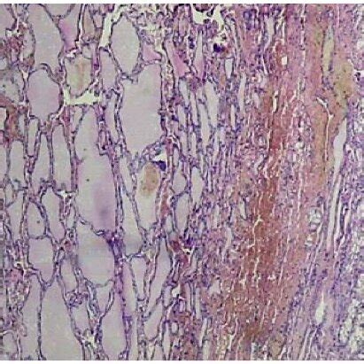Thyroid Parenchyma Infiltrated By Tumor Proliferation 1 Normal Download Scientific Diagram