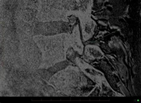 Mri Volumetric Fat Suppressed Rf Spoiled T1 Gradient Echo Sequence