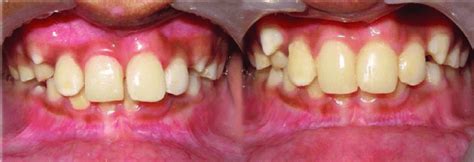 E Clinical Photo After Composite Buildup Of Both Central Incisors Download Scientific Diagram