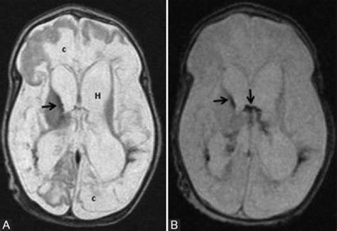 Germinal Matrix Hemorrhage Mri