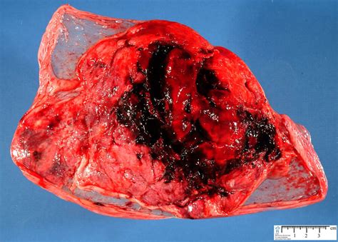 Retroplacental Hematoma Human Pathology Photos