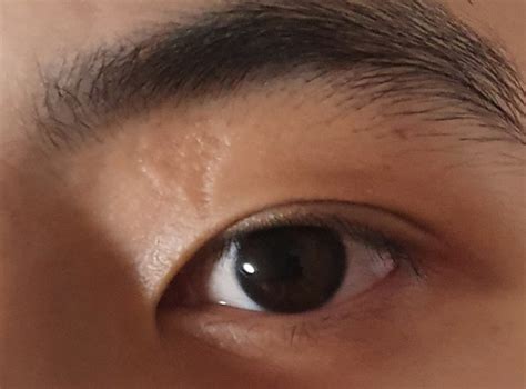 얼굴 흉터 제거문의 지식in