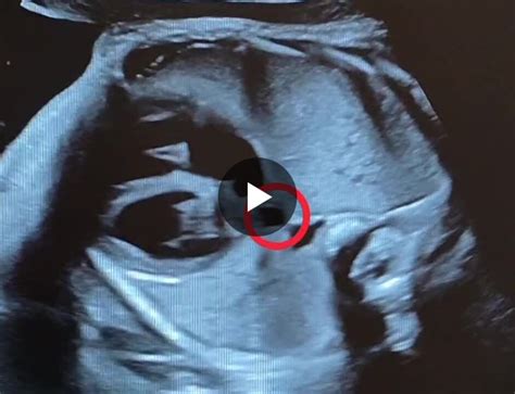 Fetal Esophagus Coskun Umit
