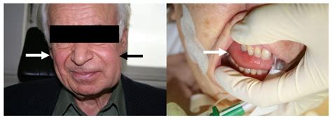Angioedema Before And After