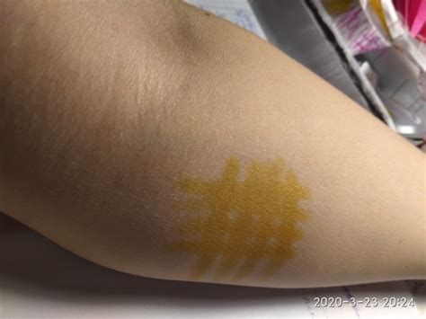 Как выглядит воспаленный лимфоузел в паху фото