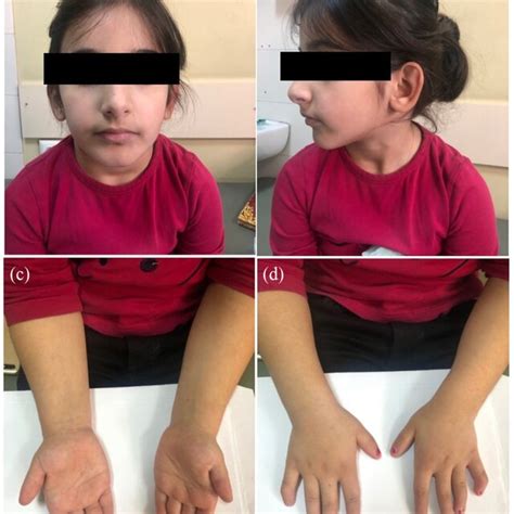 A Characteristic Dysmorphic Facial Features Including Bulbous Nose Download Scientific