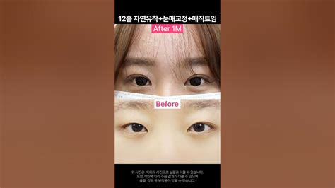 절개 없이 자연유착으로 고정력 높은 쌍꺼풀 라인 완성 Shorts Youtube