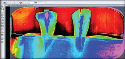 Effect Of Applying Metal Artifact Reduction Algorithm In Con Saudi Endodontic Journal