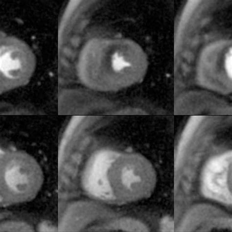 Stress Top And Rest Bottom Perfusion Images Demonstrate A Download Scientific Diagram