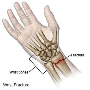 Wrist Fracture In Adults Aftercare Instructions