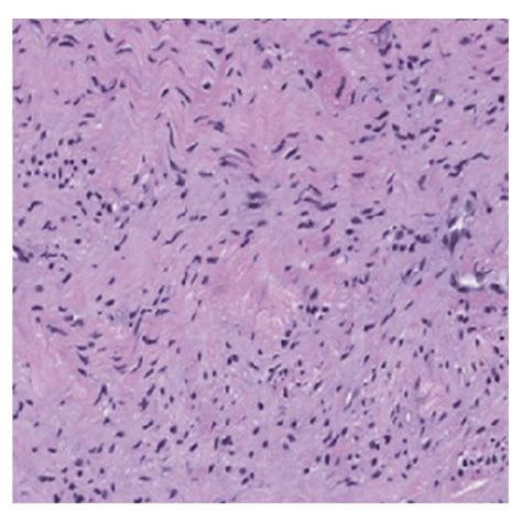 Histologically Diffuse Type Neurofibroma Arising In The Parotid Region Download Scientific