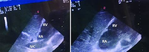 A Echo Showing Dilated Ivc And Ra B Dilated Ra And Rv Ivc Download Scientific Diagram