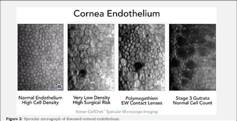 Pdf Correlation Between Corneal Endothelial Cell Characteristics And