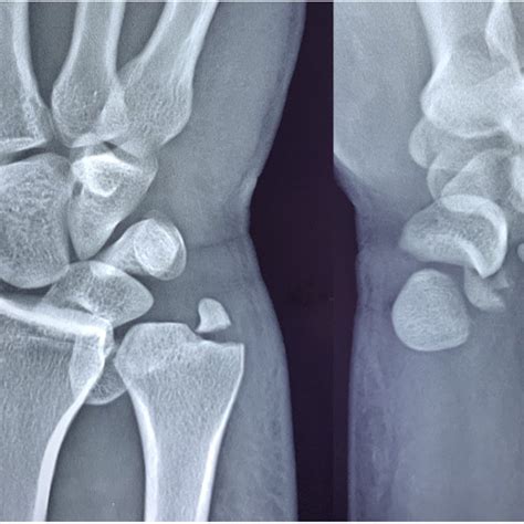 Pdf Proximal Row Carpectomy For Complex Perilunate Fracture