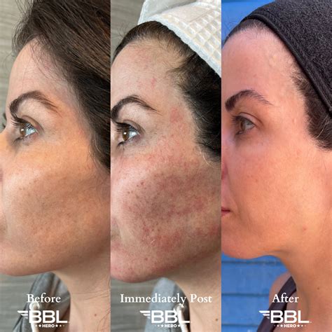 Bbl Hero Dallas Broadband Light Therapy Dallas Dallas Dermatology