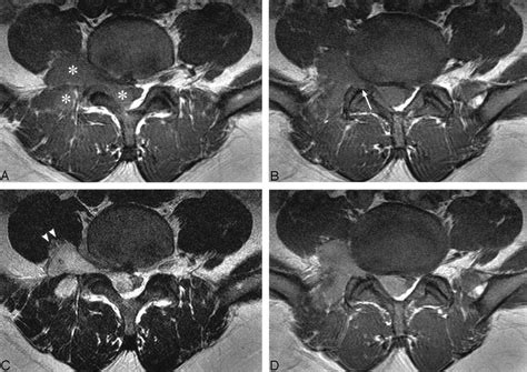 Fig 1 Spinal Epidural Synovial Sarcoma A Case Of Homogeneous Enhancing Large Paravertebral