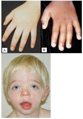 Neurodegenerative With Multiple Congenital Malformation Flashcards Quizlet