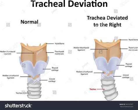 Tracheal Deviation Patient Had A Very Enlarged Thyroid Which Caused